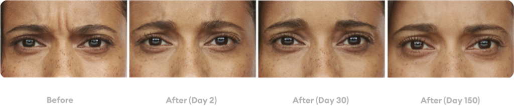 Jeuveau® | Pipeline Medical Your Medical Procurement Partner