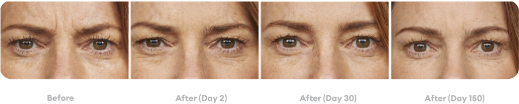 Jeuveau® | Pipeline Medical Your Medical Procurement Partner